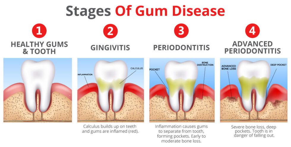 What You Need to Know About Gum Care - Emergency Dental Care & In Home ...